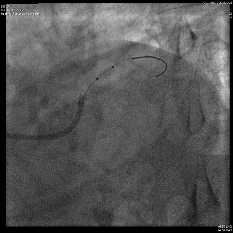Fisiología Coronaria - Cardio Intervención